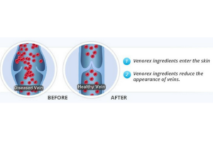 Venorex Review - Best Varicose Vein Removal Cream - Lifestylica