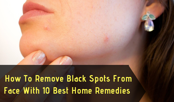 How to Remove Black Spots From Face With 10 Best Home Remedies ...